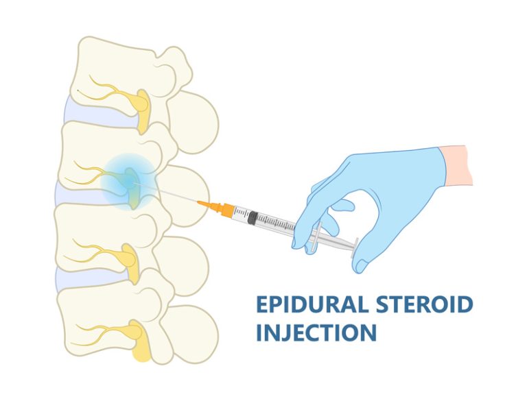 Epidural Steroid Injections - Pain Institute of Southern Arizona