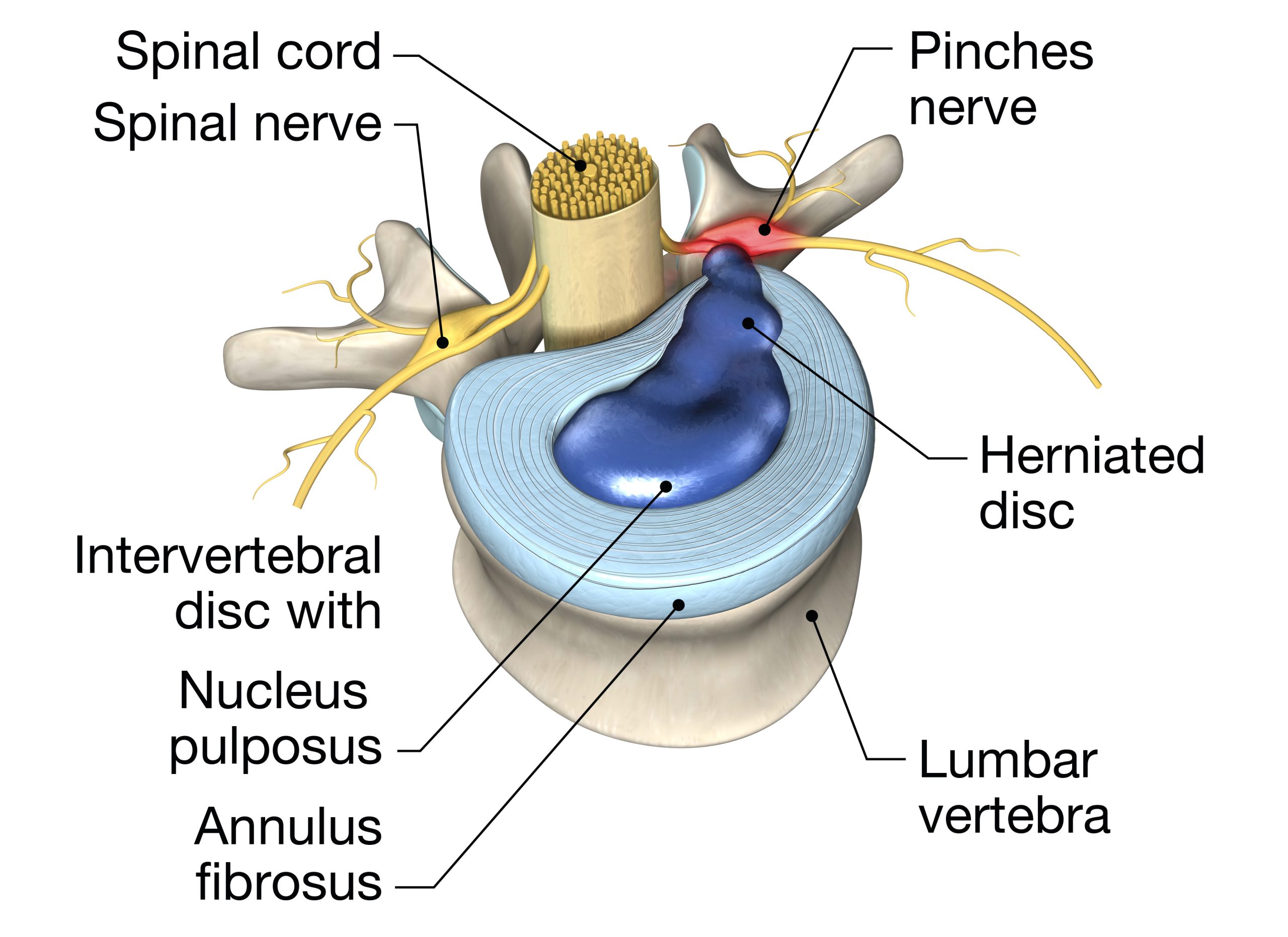 “When a disc slips, your body signals.” - Pain Institute of Southern ...