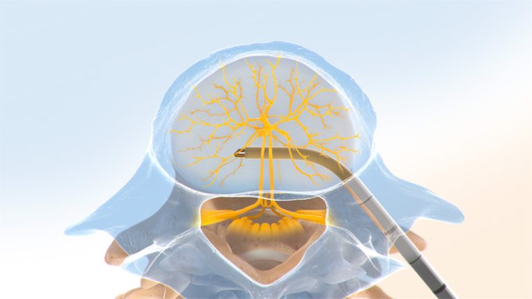 Intracept® Procedure - Pain Institute of Southern Arizona