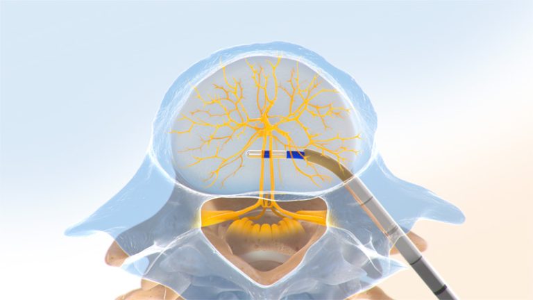 Intracept® Procedure - Pain Institute of Southern Arizona