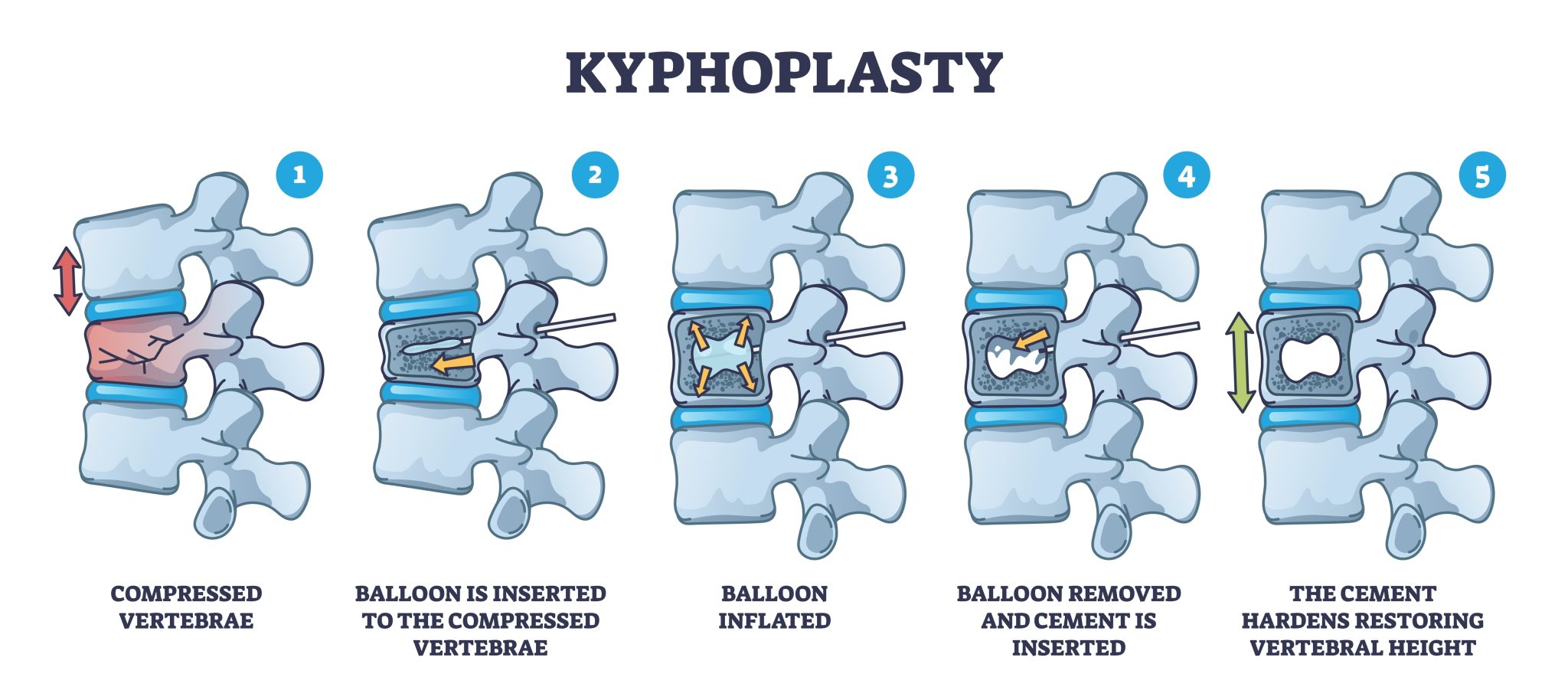 Kyphoplasty - Pain Institute of Southern Arizona