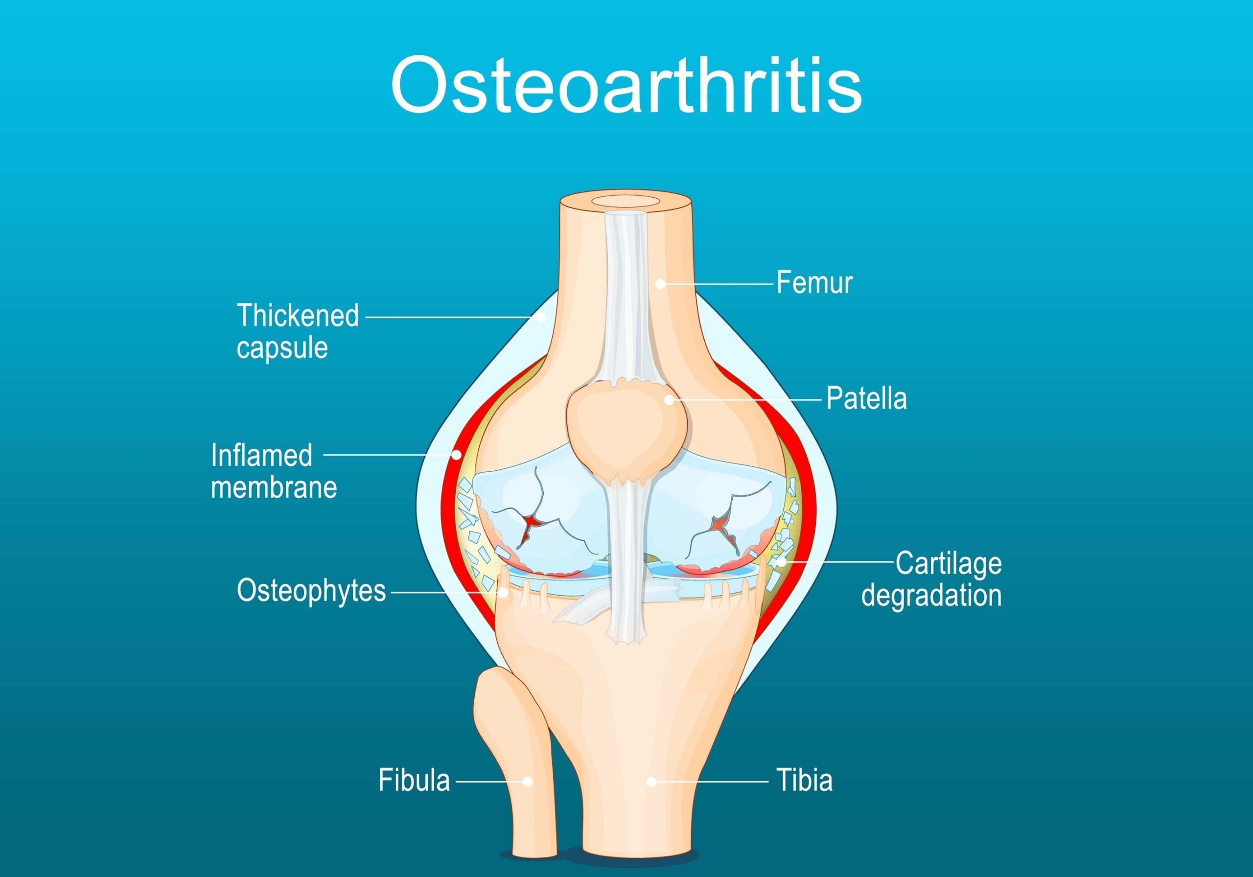 “Ease the Wear, Rediscover Comfort—Understanding Osteoarthritis ...