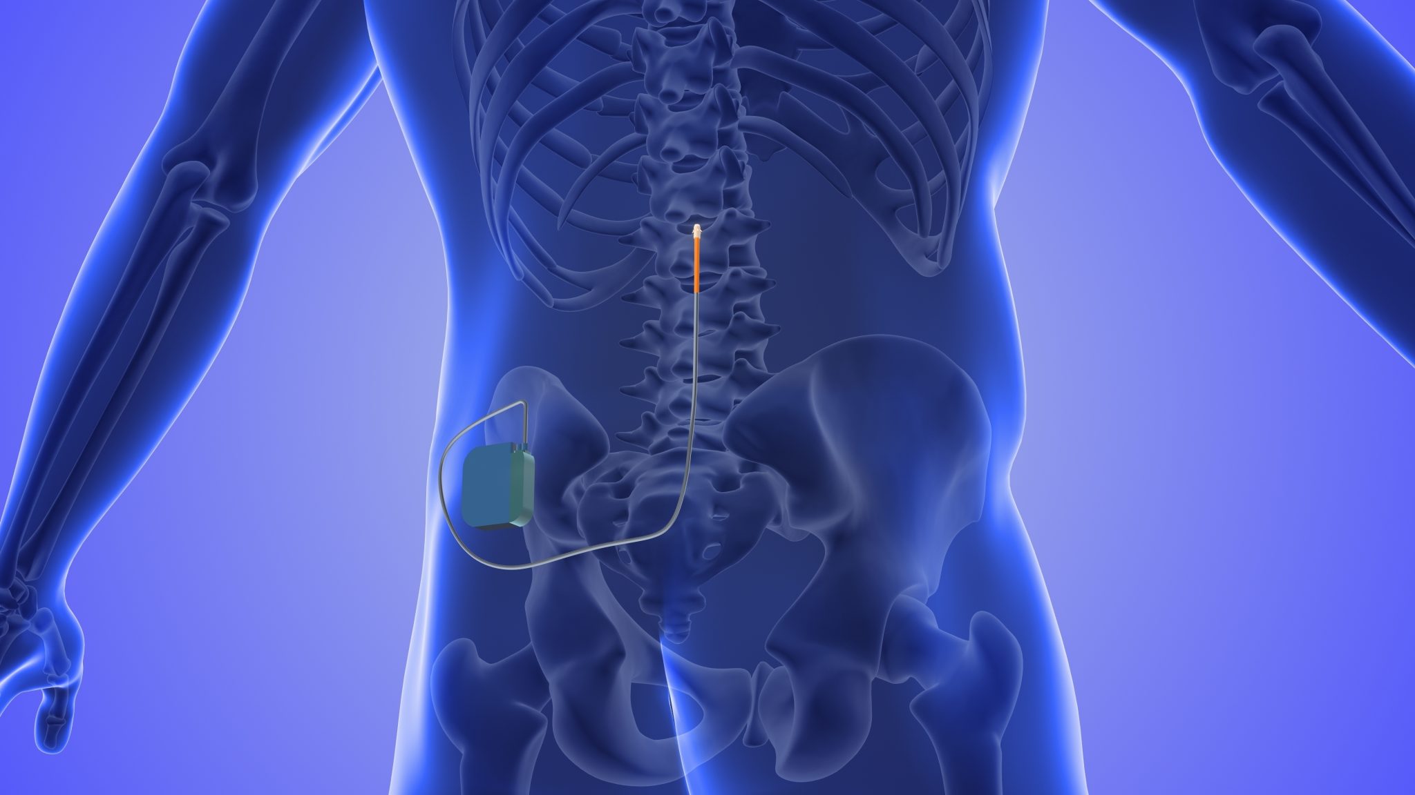Spinal Cord Stimulator - Pain Institute of Southern Arizona
