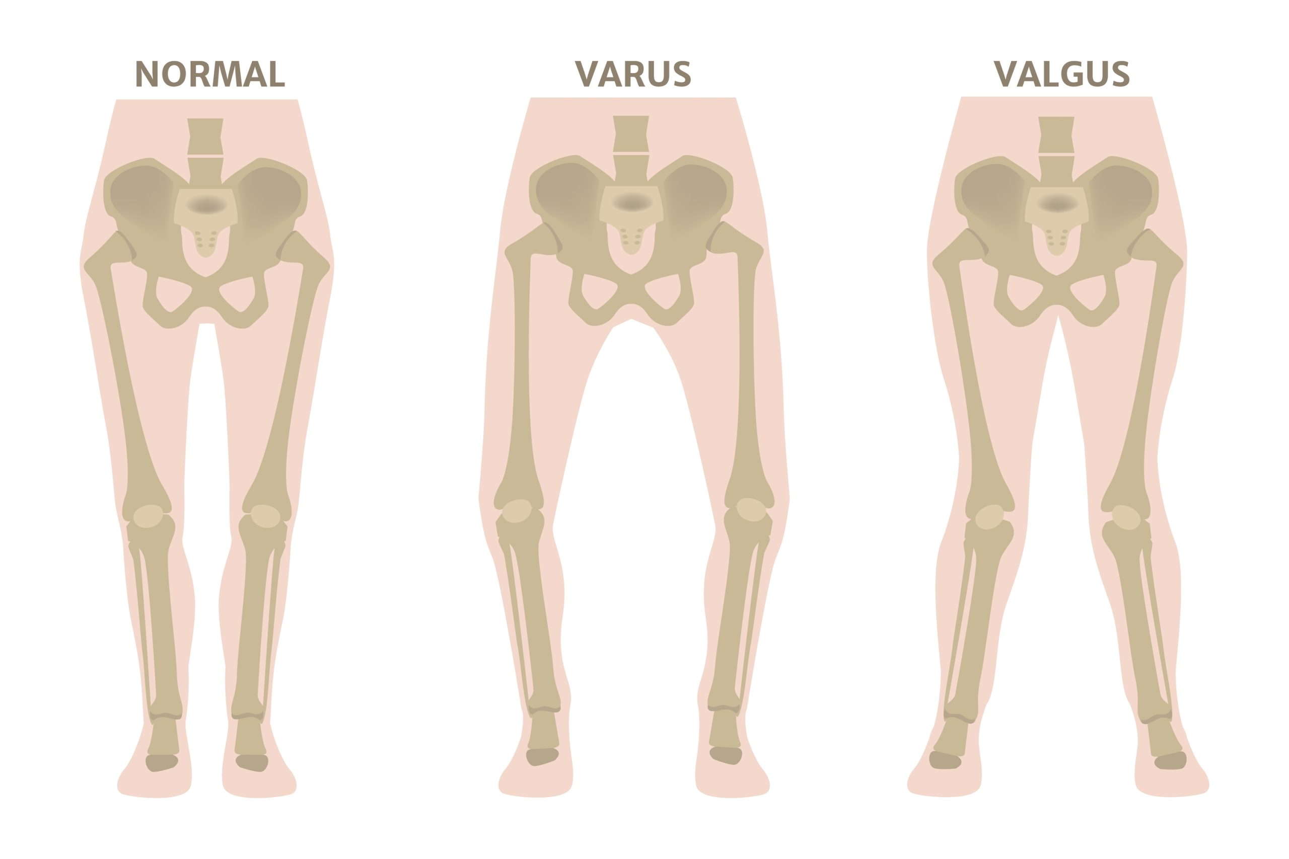 “Varus or Valgus – When Alignment Matters for Every Step!” - Pain Institute of Southern Arizona